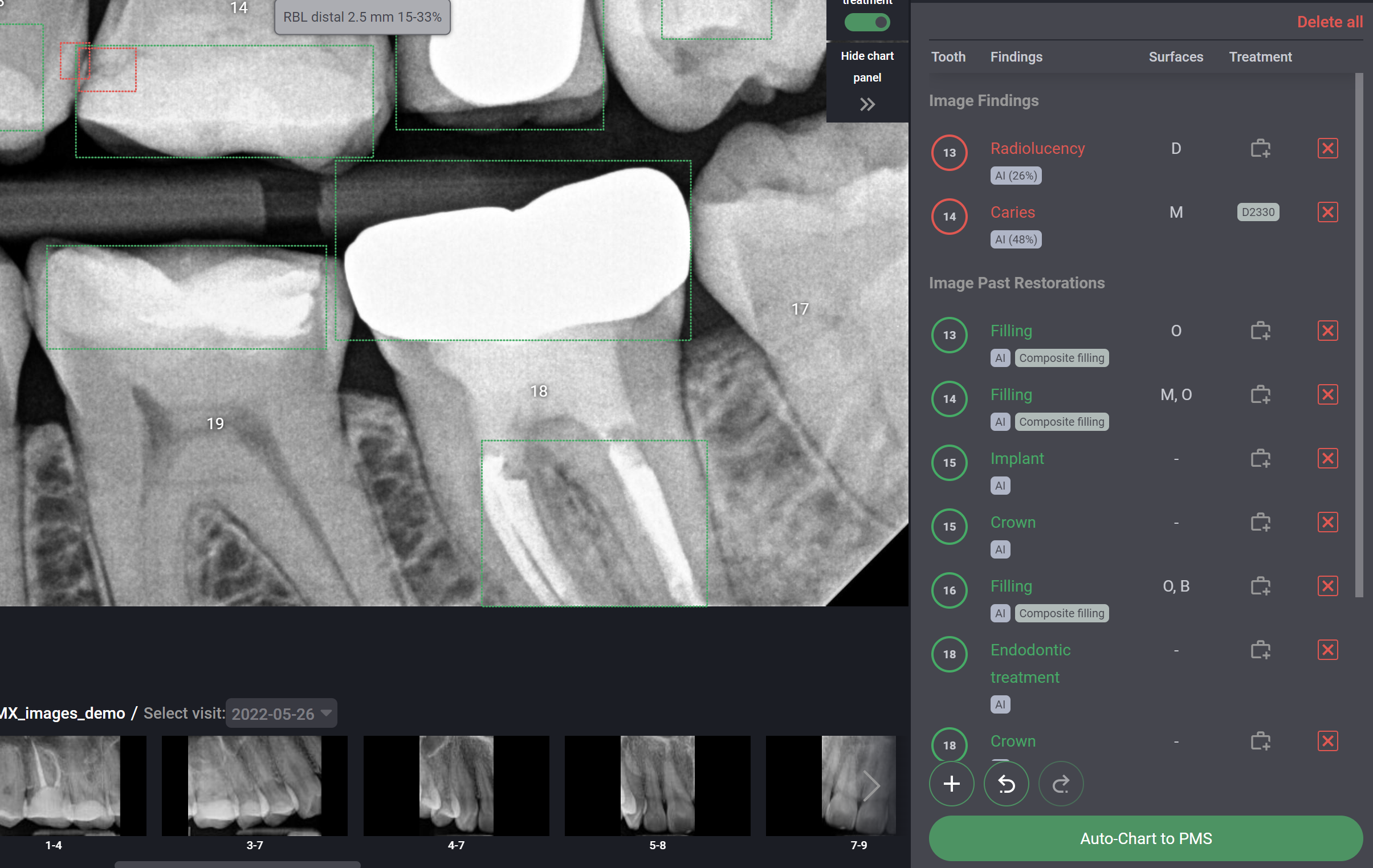 Denti.AI: AI for Dental X-Ray Imaging and Voice Charting